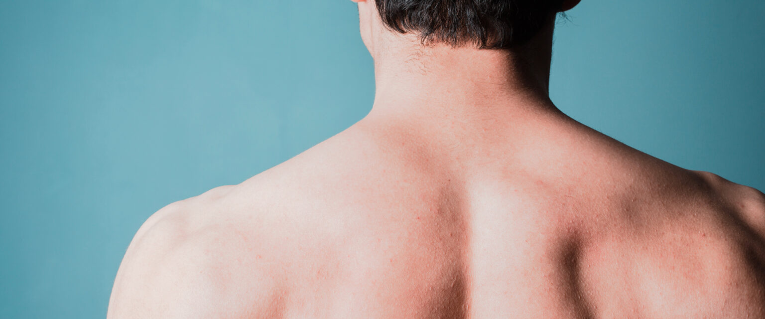 Permanent back hair removal for men: how many sessions ...