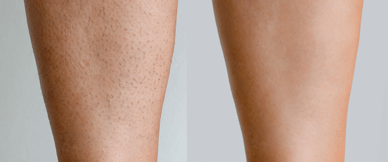 Qual è la differenza tra epilazione e depilazione? | epìLate